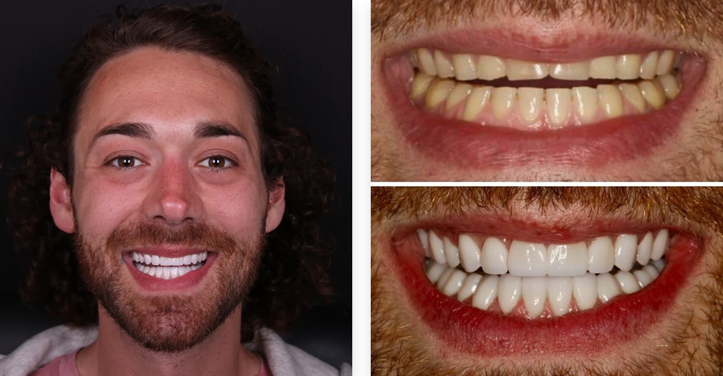Nate’s Smile Transformation: From Insecurity to Confidence - Peninsula ...